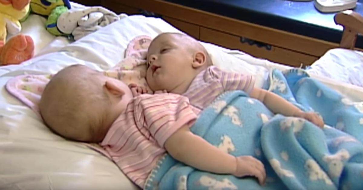 The Twins Were Born Conjoined. 10 Years Later, The Miracle Girls Are ...