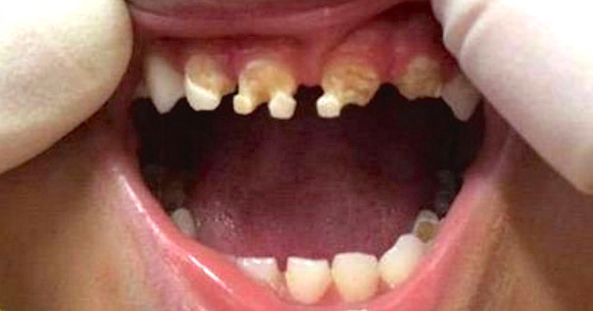 Doctor Warns Parents About The Dangers Of Tooth Decay.