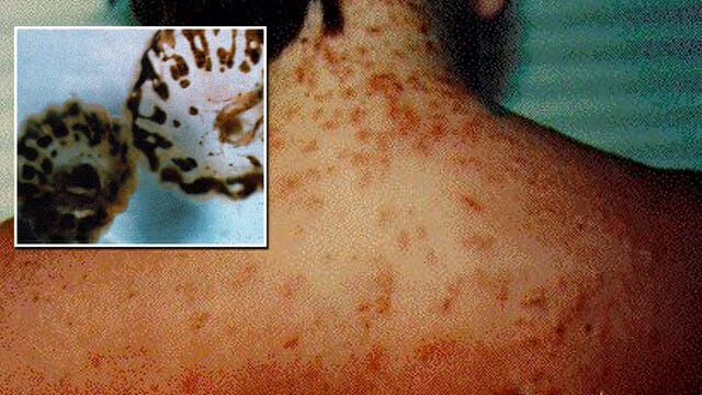 Sea lice break out in Florida – experts issue warning