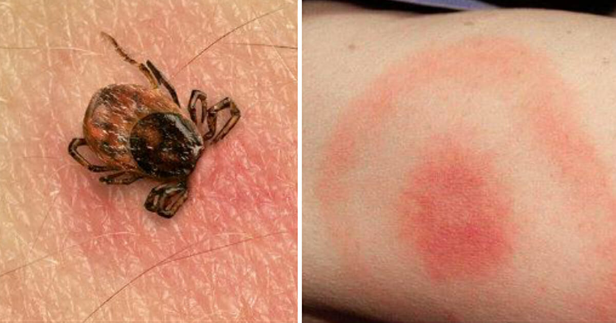 These Are The Signs Of A Tick Bite To Look For This Season