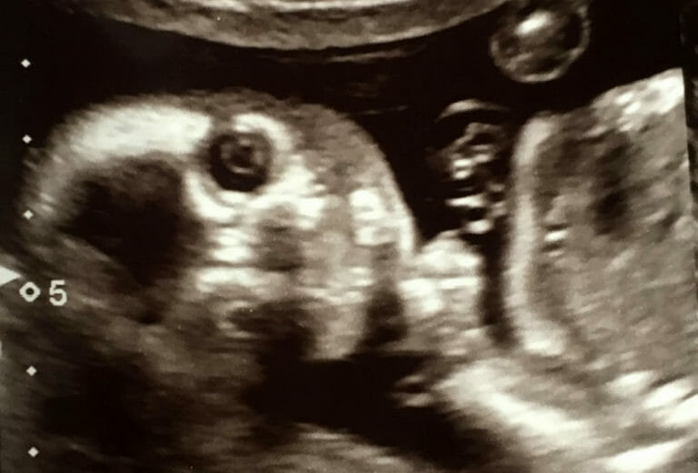 Mom shocked as unborn baby turns and stares at camera in 'creepy' scan