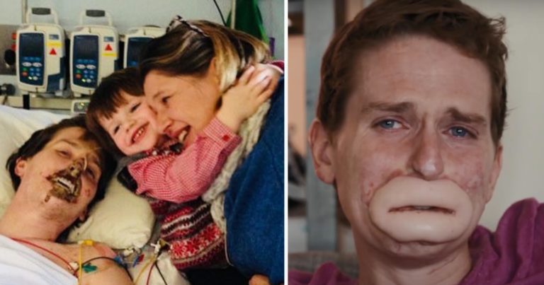 Dad left unrecognizable after losing his lips and four limbs to flesh ...