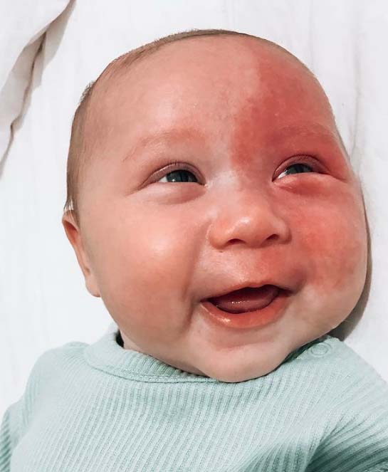 Mum labeled "monster" for lasering port-wine stain birthmark on her ...