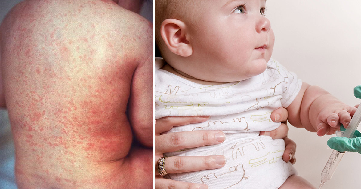 Varningen: föräldrar uppmanas vaccinera sina barn mot farliga smittan
