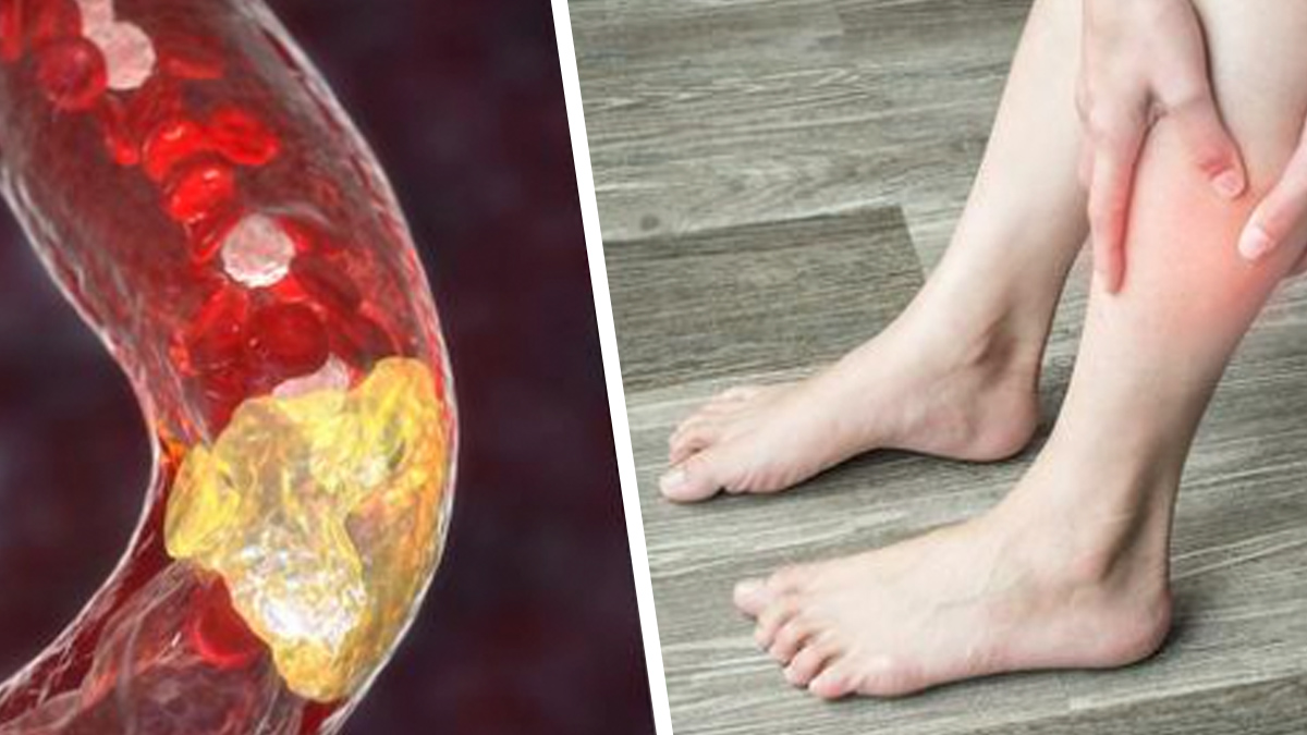 Nämä ovat veritulpan yleisimmän oireet, joita moni ei osaa tunnistaa ...