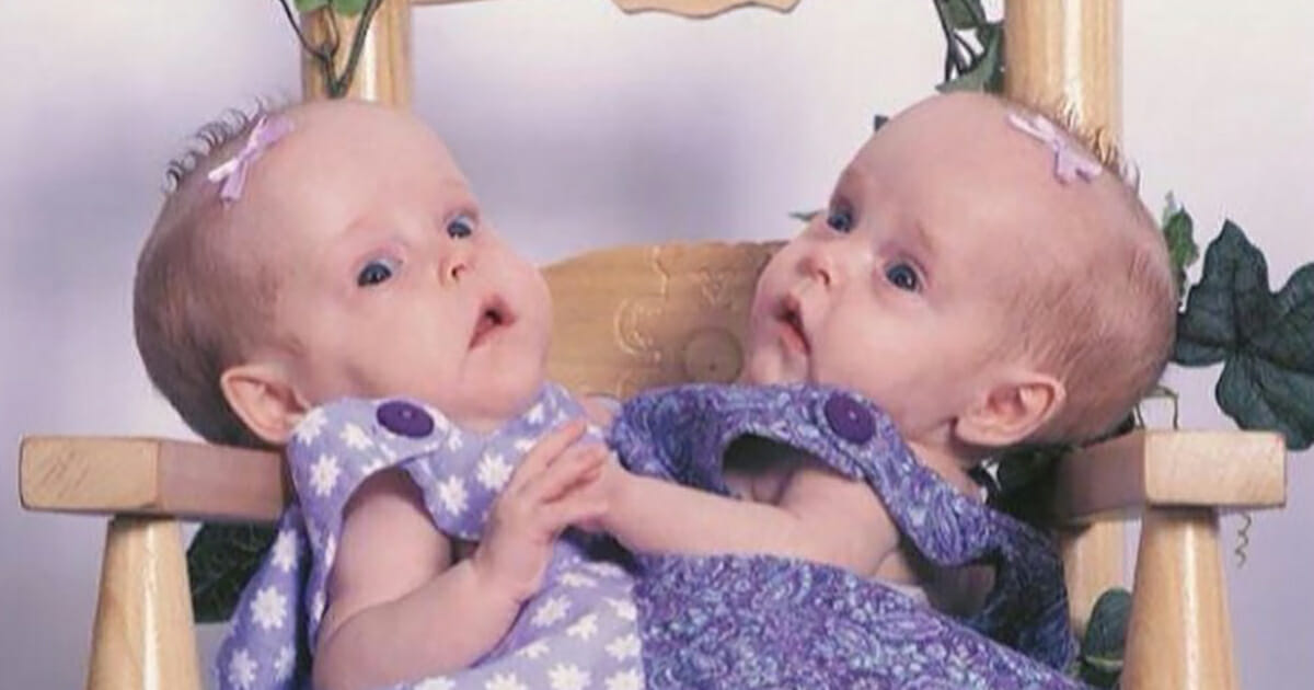 Gêmeas siamesas que foram ‘cortadas na metade’ em 2006 estão agora ... Gêmeas siamesas que foram ‘cortadas na metade’ em 2006 estão agora ...