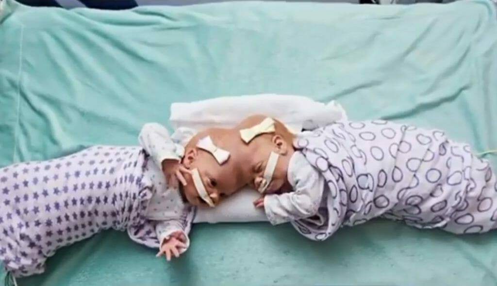 Siamese tweeling geboren met hoofd aan elkaar gegroeid - zie hoe ze er ...