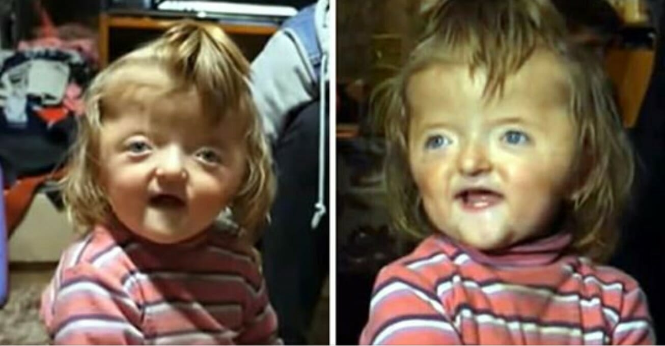 Meisje (2) verbannen uit kleuterschool omdat haar misvormde schedel ...